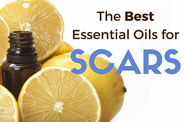 Best Essential Oils for Scars - Acne, Burns & Surgical Scars